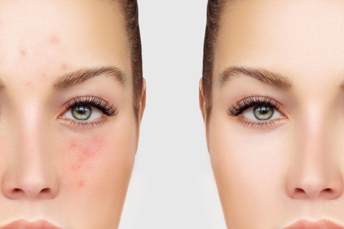 Acne & Rosacea | Reno Tahoe Dermatology | Best Reno Dermatologist