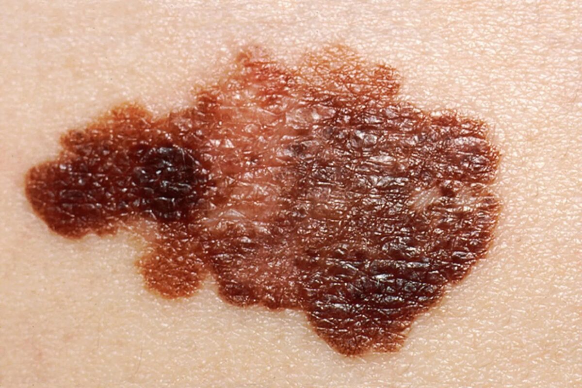 Moles & Melanomas | Reno Tahoe Dermatology | Best Reno Dermatologist