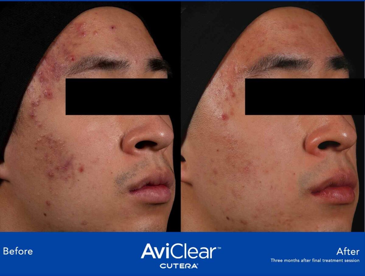 AviClear | Reno Tahoe Dermatology | Best Reno Dermatologist