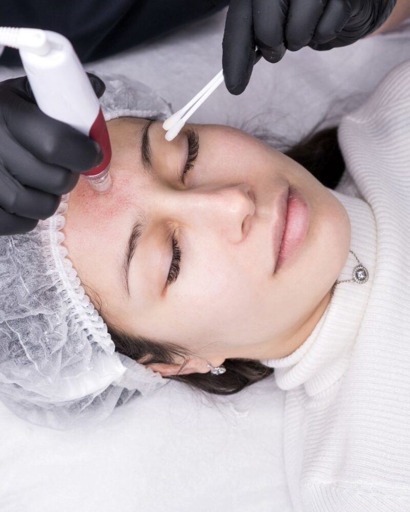 Microneedling | Reno Tahoe Dermatology | Best Reno Dermatologist