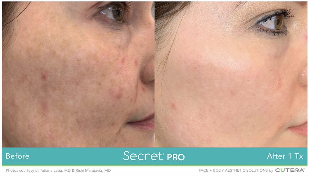 Secret Pro | Improve Skin Tone & Reduce Fine Lines | Reno Tahoe Dermatology