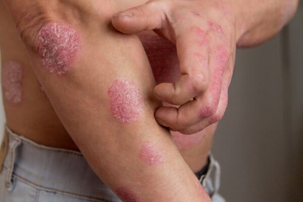Psoriasis Articles | Reno Tahoe Dermatology